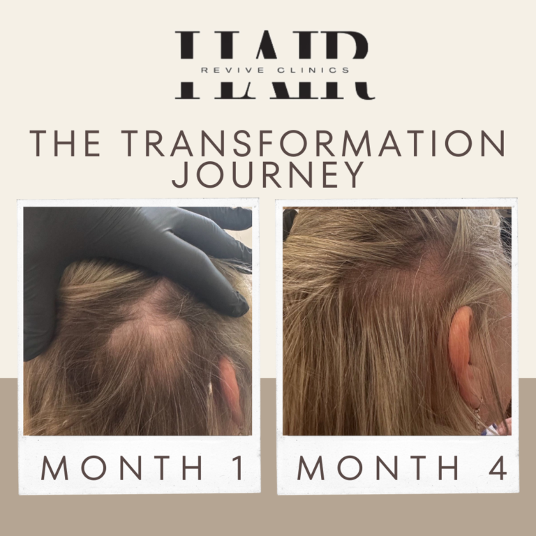 Hair Revive Clinics | Hair Restoration Experts